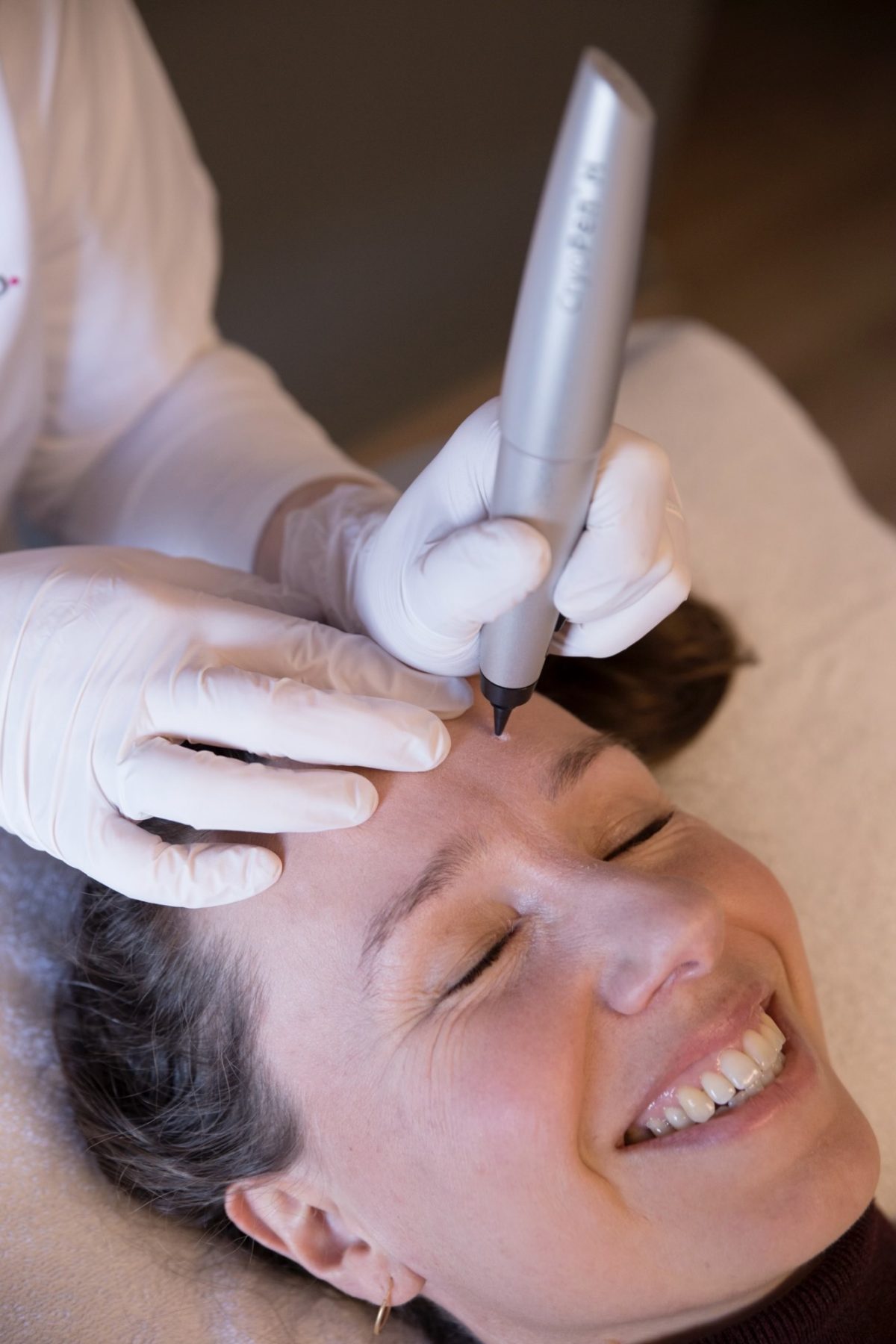 Cryopen: Verwijdering huidoneffenheden met Cryotherapie